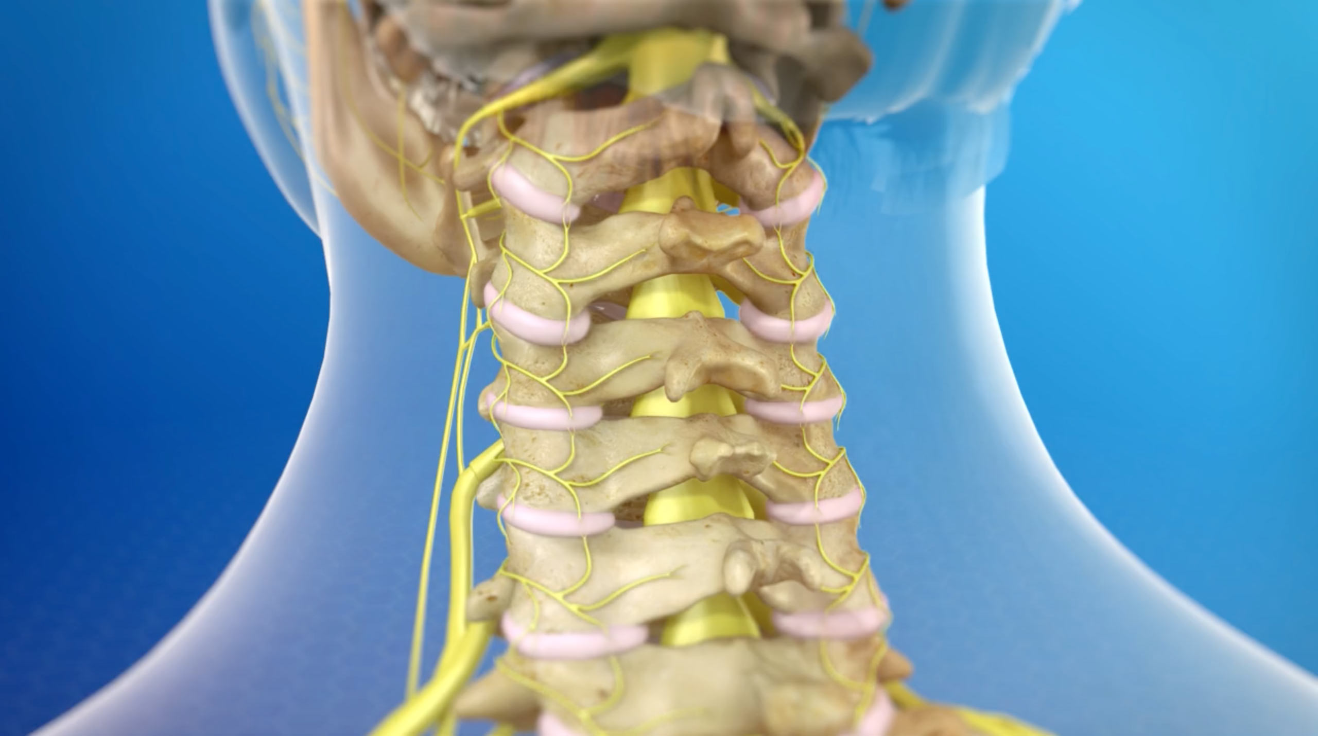 Cervical Radiofrequency Ablation For Neck Pain Des Moines Iowa Cervical Radiofrequency Ablation For Neck Pain Des Moines Iowa