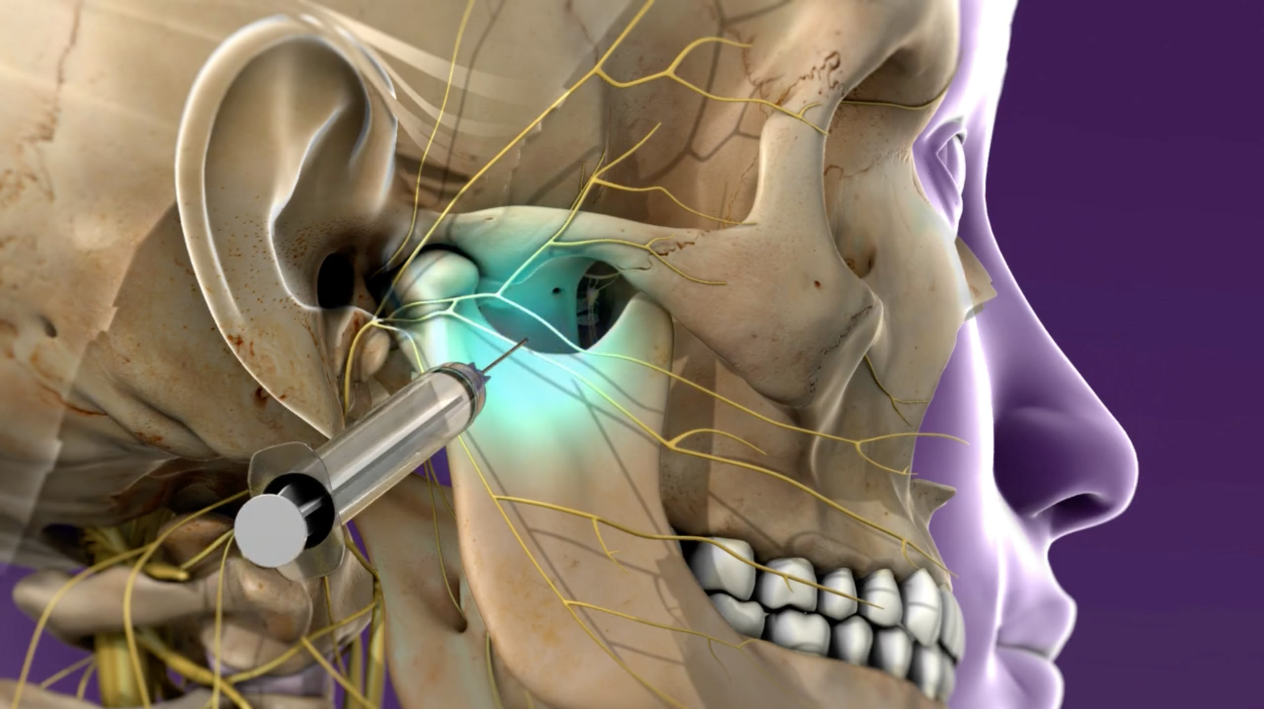 Nerve Block - Central States Pain Clinic